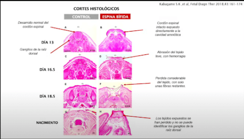 Corrección intrauterina de mielomeningocele por fetoscopia: primera ...